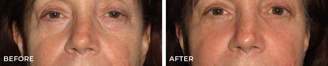 Valencia Eyelid Surgery | Blepharoplasty in Valencia | Eyesthetica ...