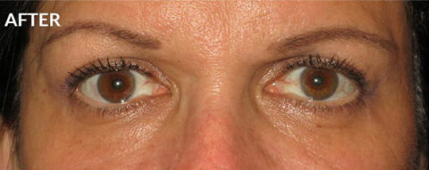 Brow Lift in Greater Los Angeles | Eyesthetica